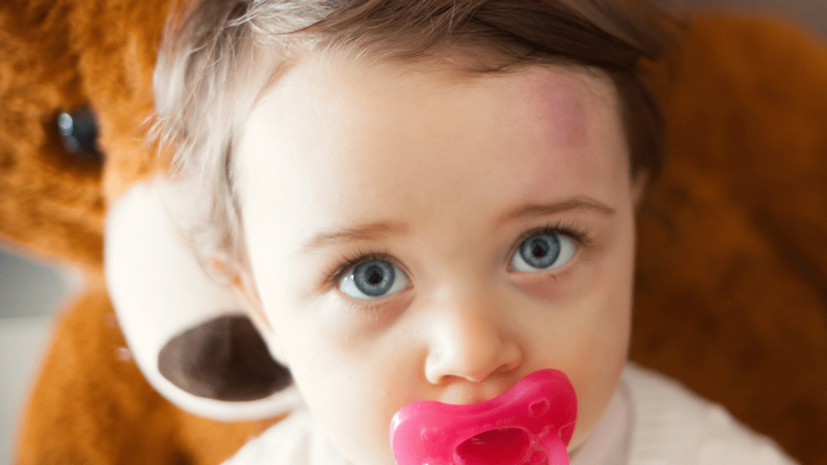 ¿Qué puedo hacer si mi hijo se hace un chichón con un golpe?